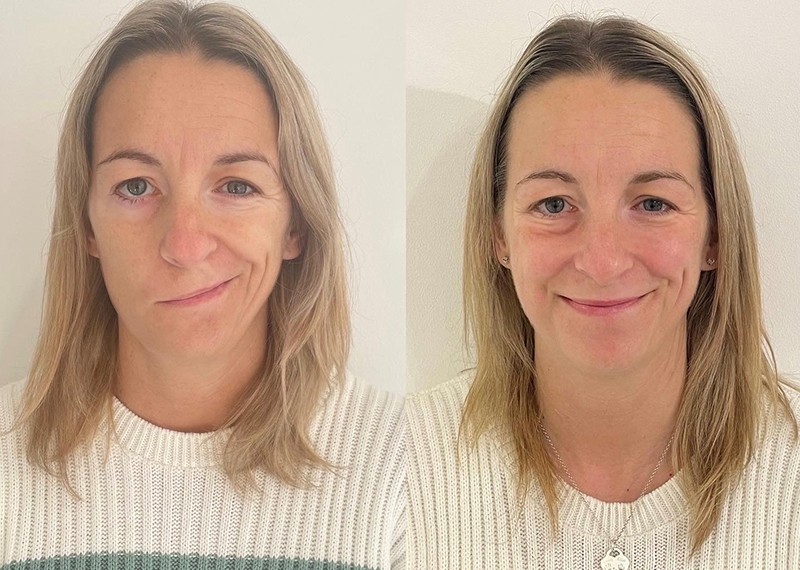 CACI Synergy delivers successful Bell’s Palsy treatment